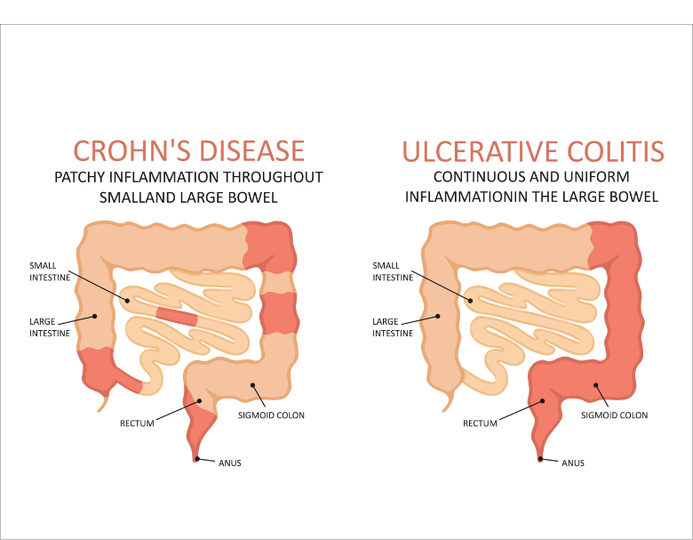 Inflammatory Bowel Disease (IBD) Diagnostics | Grifols Diagnostics
