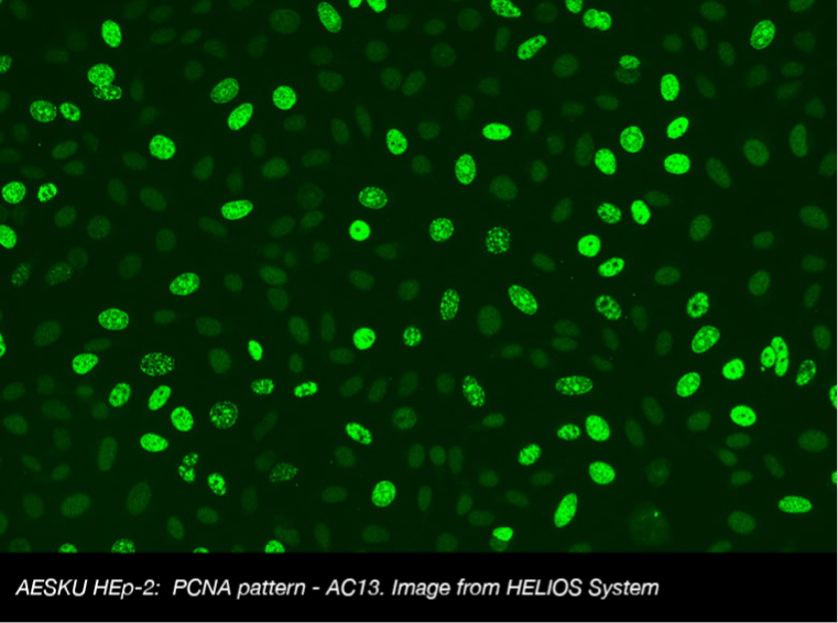 Systemic Autoimmune Rheumatic Diseases (SARDS) Diagnostics