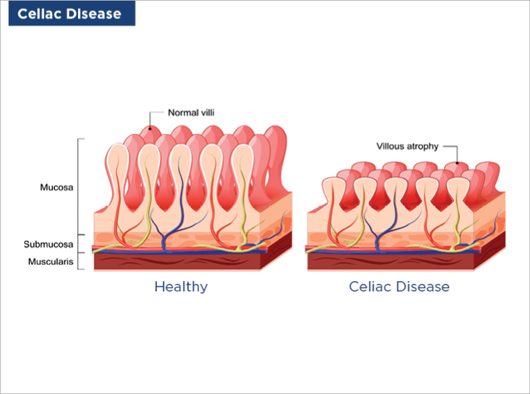 Celiac Disease Diagnostics
